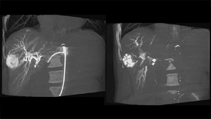 Tumor embolization | Philips