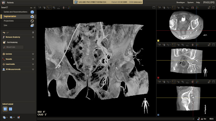Prostate Artery Embolization (PAE) | Philips